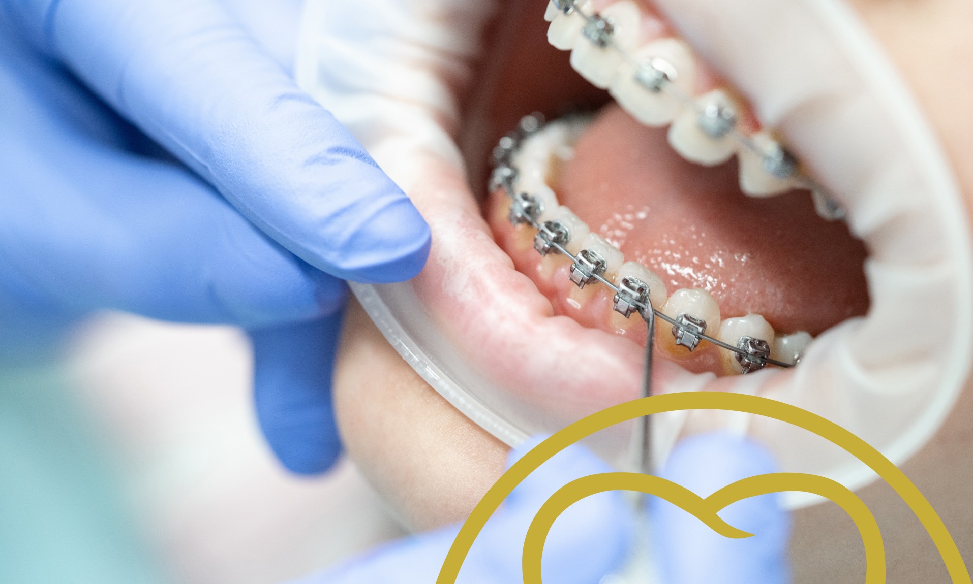 Straight Wire Braces Are the Most Reliable Choice